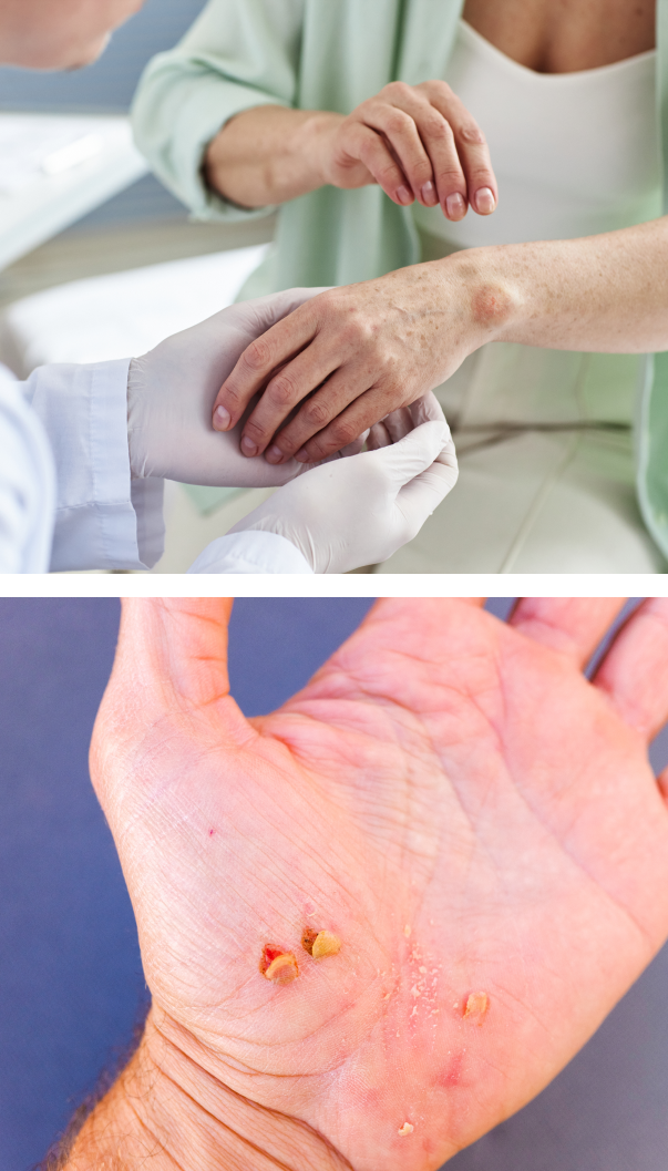 Skin Cancer on the Hands | Skin Check Australia