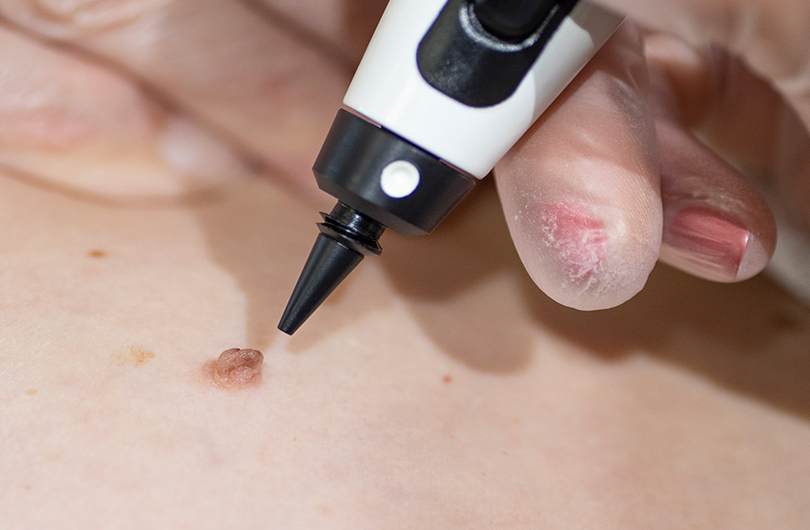 skin check services Australia | Mole/Skin Tag Removal & Cryothera