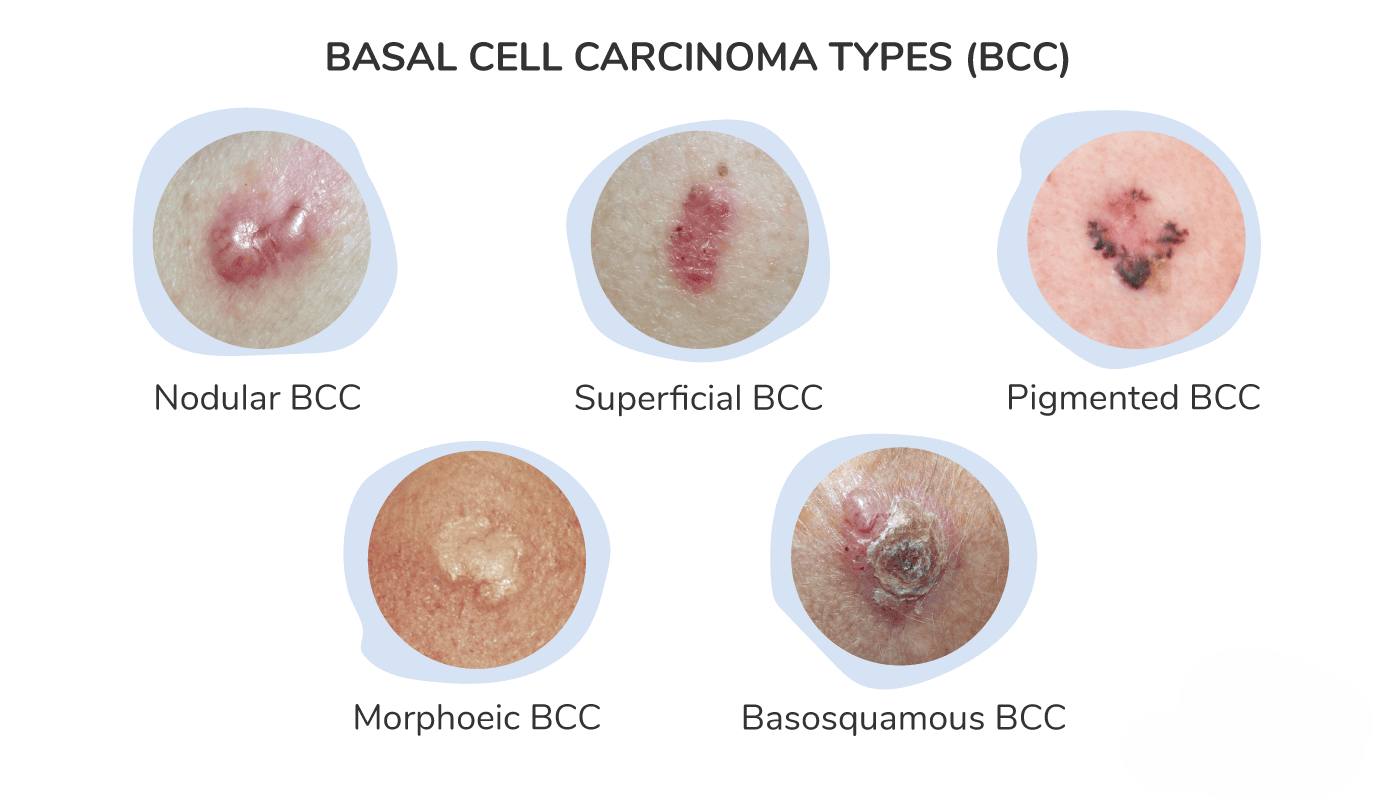 Types of skin cancer | Understanding the Three Main Types of Skin Canc