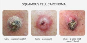 Types of skin cancer | Understanding the Three Main Types of Skin Canc