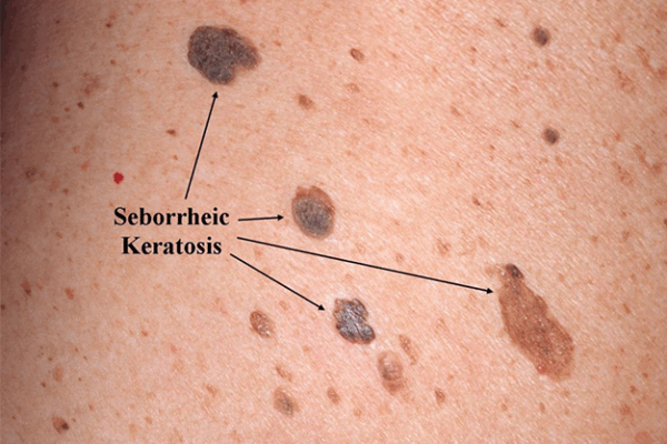 Skin cancer check Australia | Actinic Keratosis vs Seborrheic Keratosi
